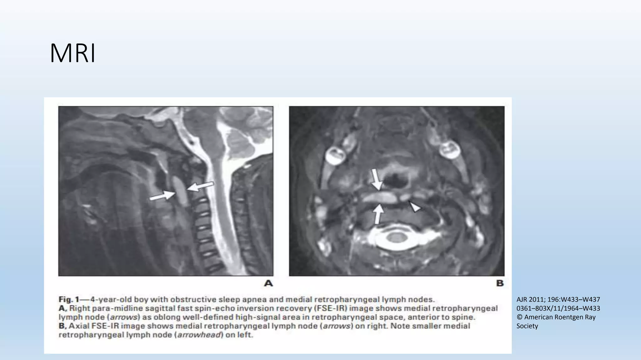 Retropharyngeal space | PPTX
