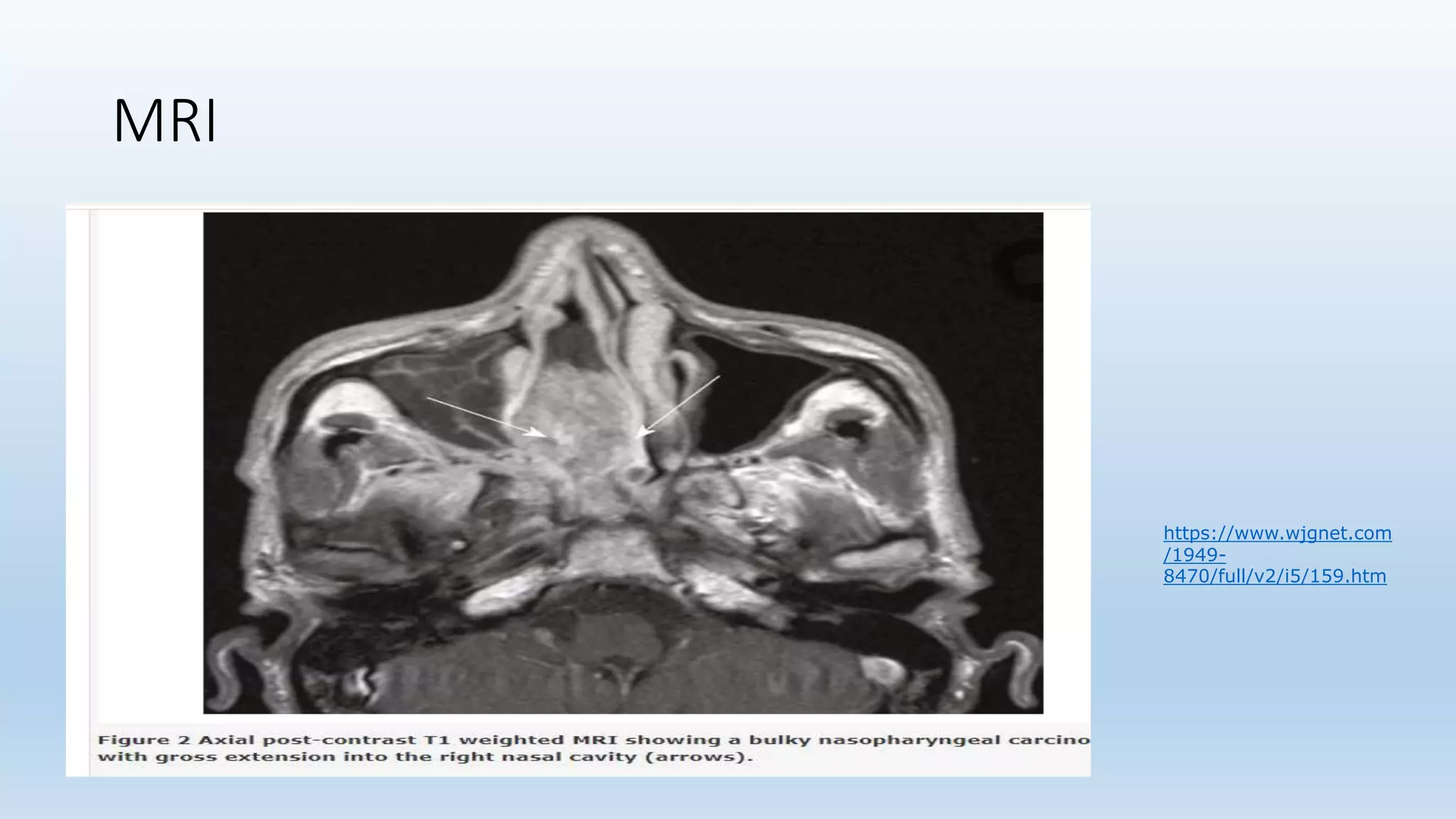 Retropharyngeal space | PPTX