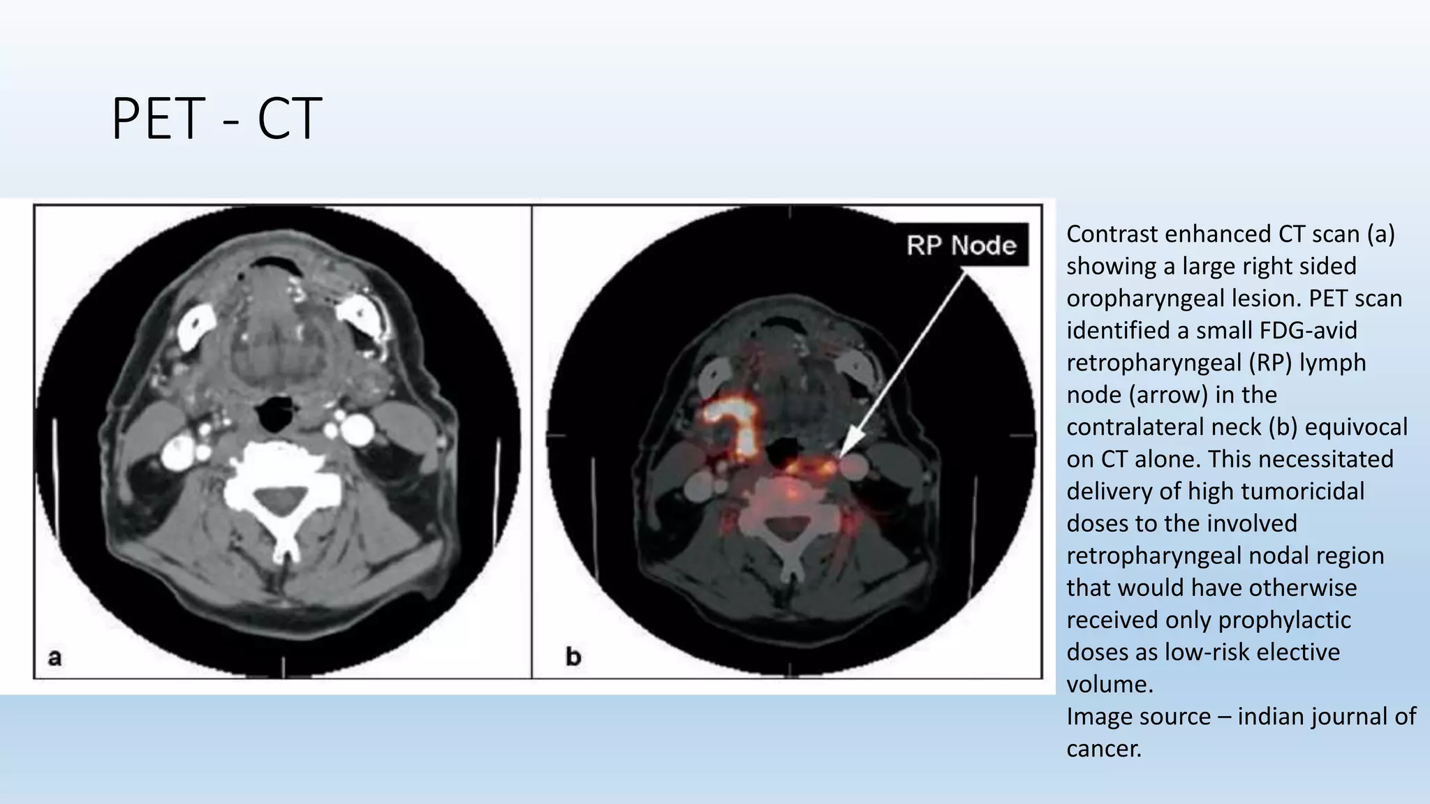 Retropharyngeal space | PPTX
