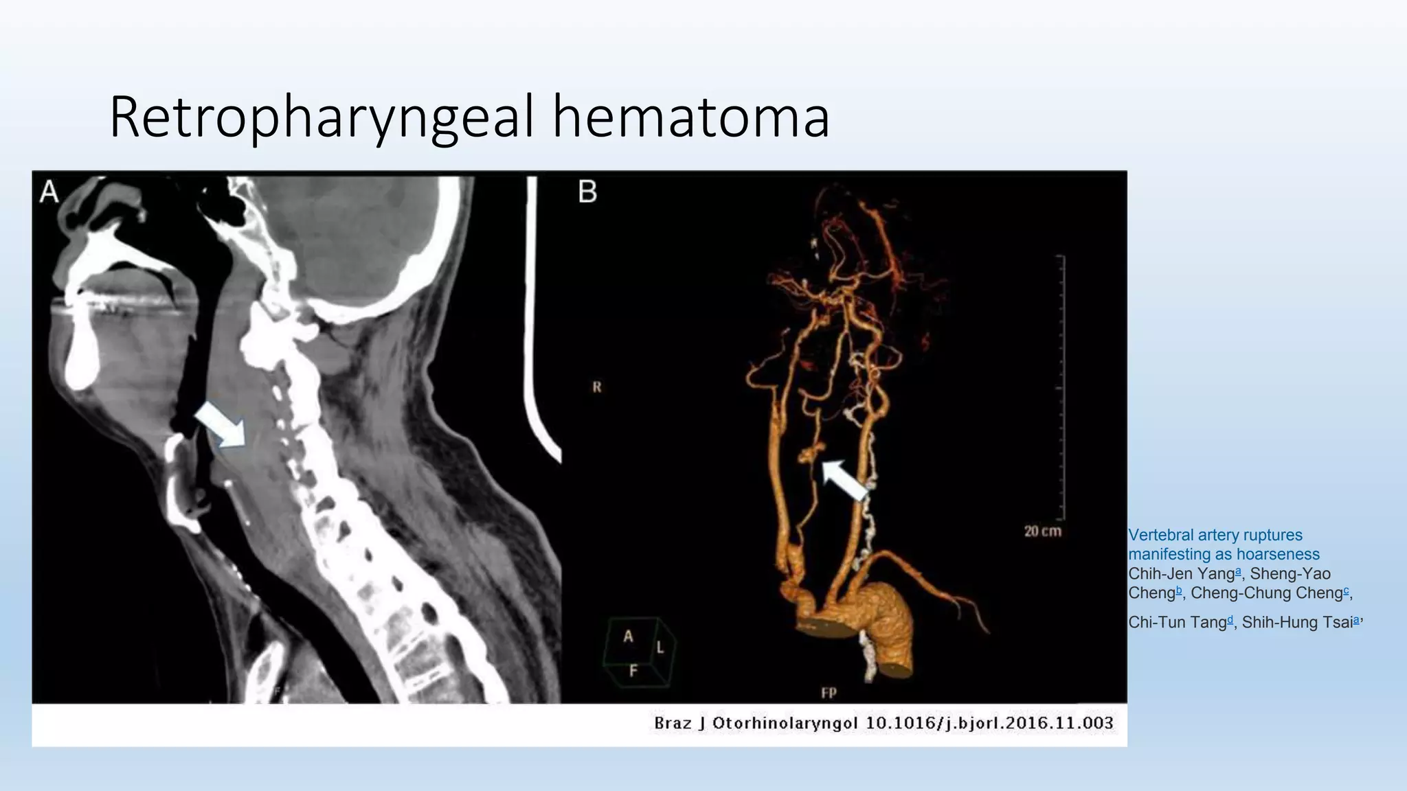 Retropharyngeal space | PPTX