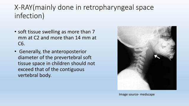 Retropharyngeal space | PPTX