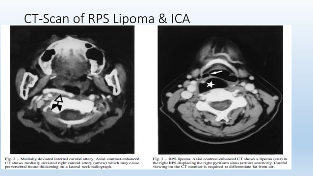 Retropharyngeal space | PPTX