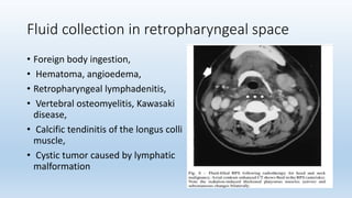 Retropharyngeal space | PPTX