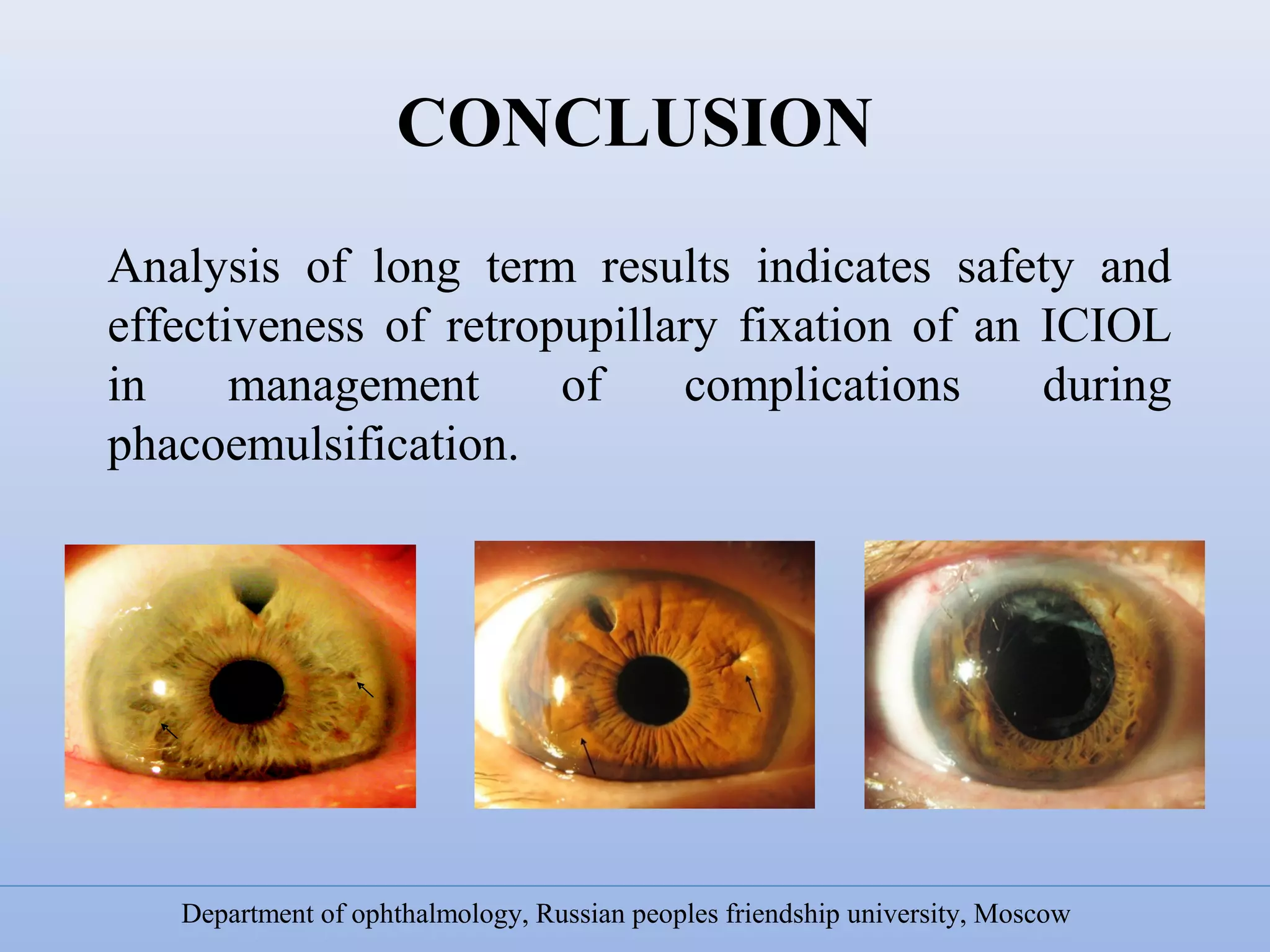 Retropupillary fixation of iris claw iol in phaco complication | PPT