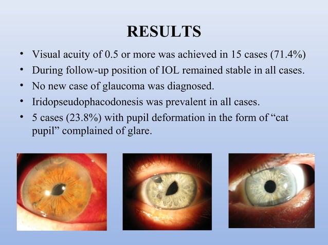 Retropupillary fixation of iris claw iol in phaco complication