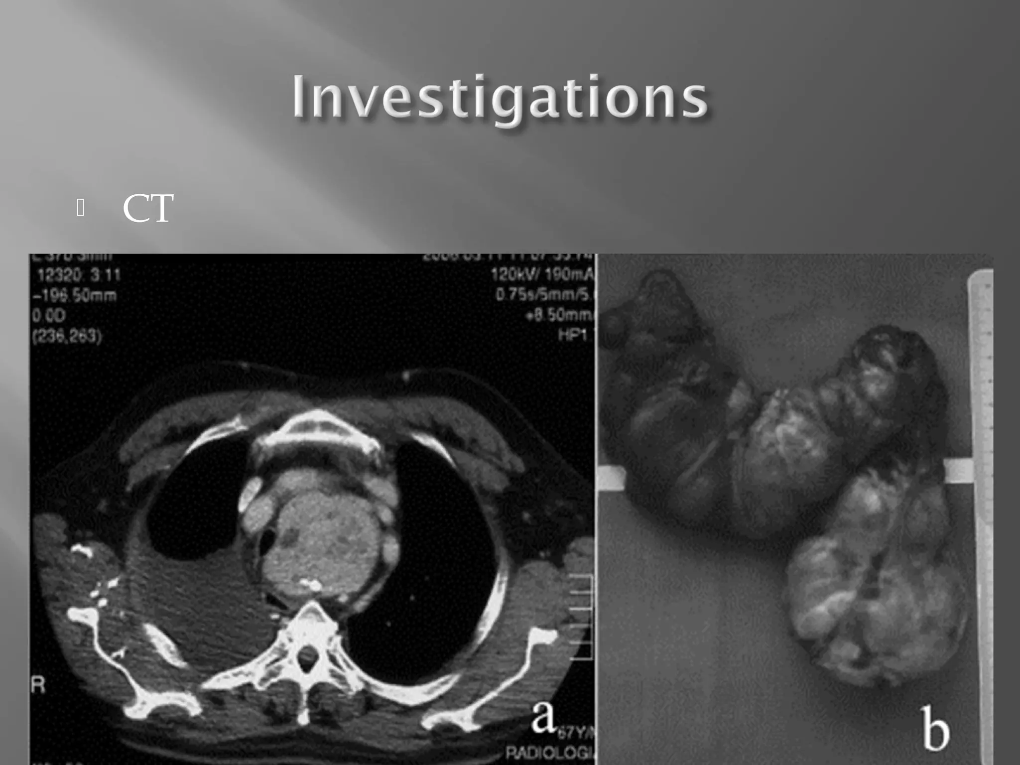Retrosternal goiter | PPT