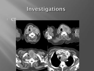 Retrosternal goiter | PPT