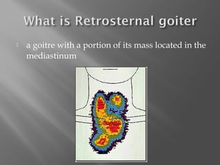 Retrosternal goiter | PPT