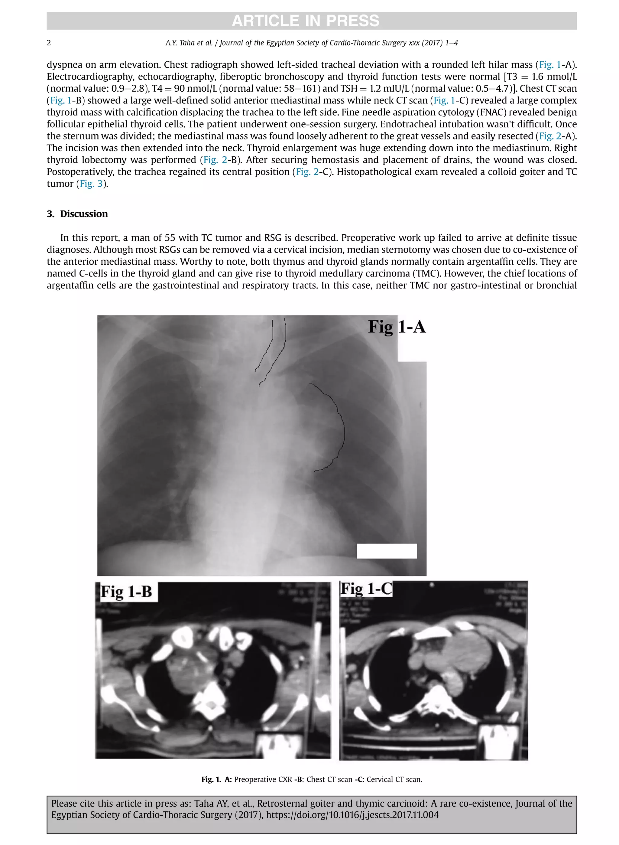 Retrosternal goiter and thymic carcinoid a rare co existence | PDF