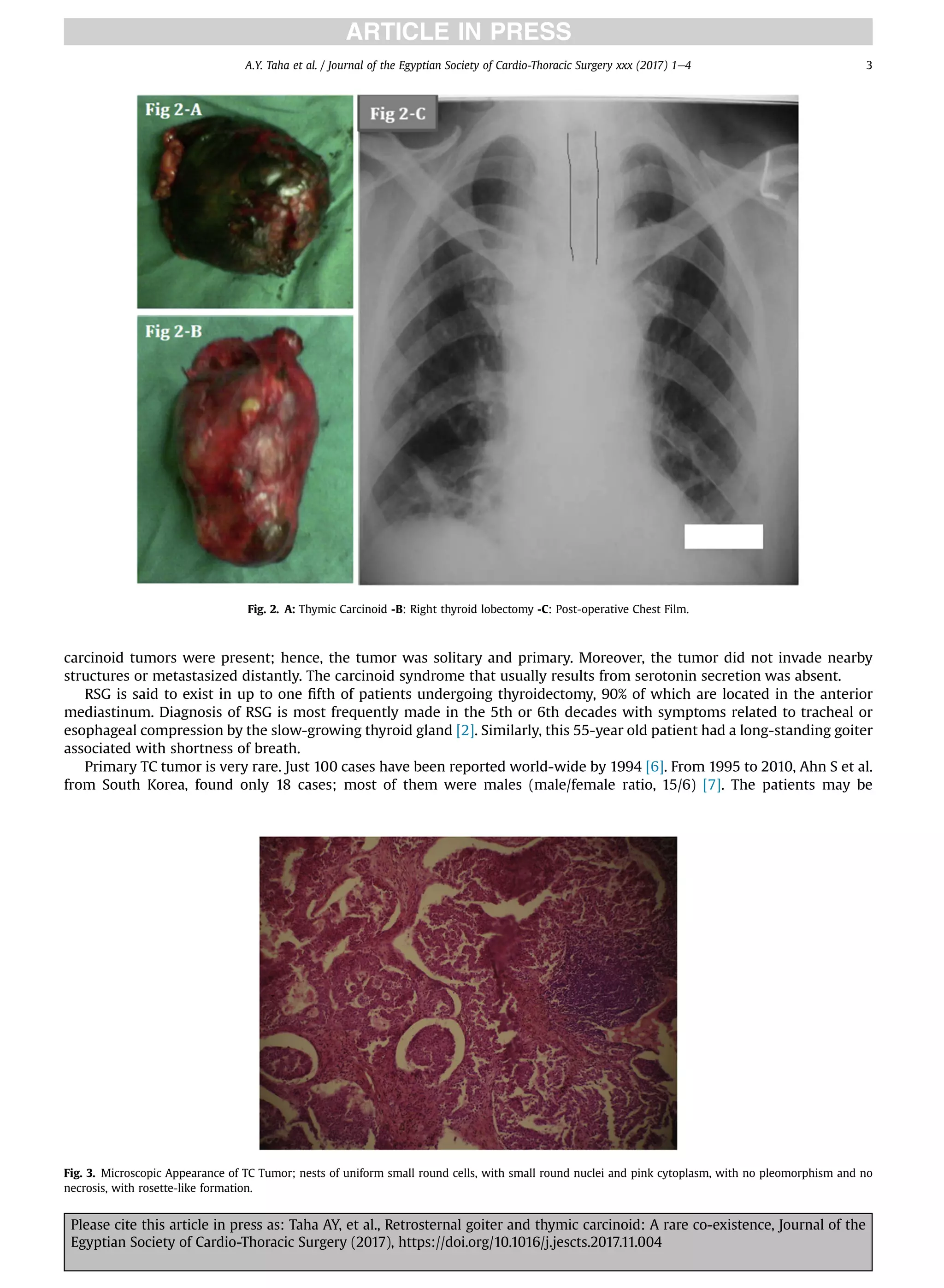 Retrosternal goiter and thymic carcinoid a rare co existence | PDF