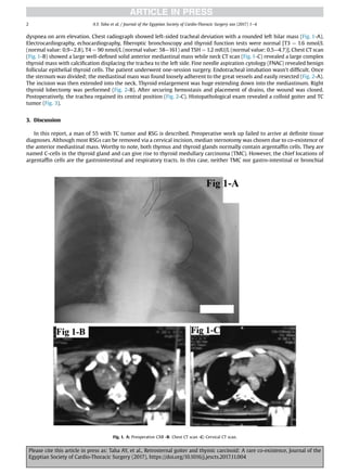 Retrosternal goiter and thymic carcinoid a rare co existence | PDF