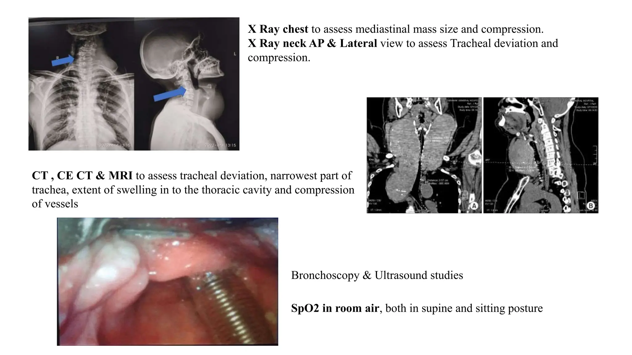 Retrosternal ppt workshop GAS.pptx