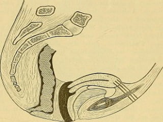 Retroverted retroflexed uterus &uterine inversion | PPT