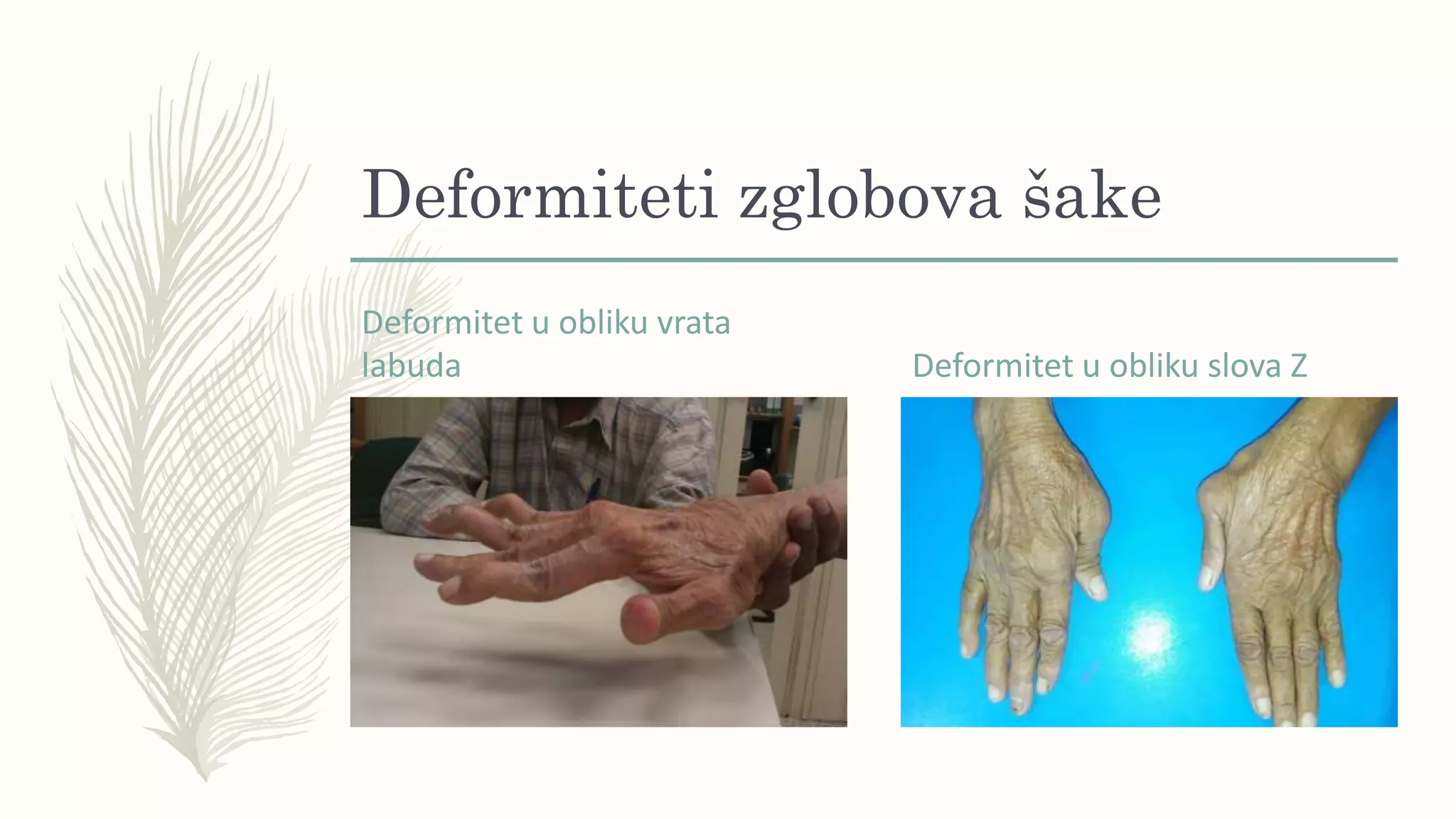 Reumatoidni artritis - interna medicina | PPTX