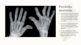 Reumatoidni artritis - interna medicina | PPTX