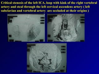 Revascularisation of the Brain In Acute Stroke | PPT