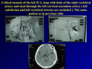 Revascularisation of the Brain In Acute Stroke | PPT
