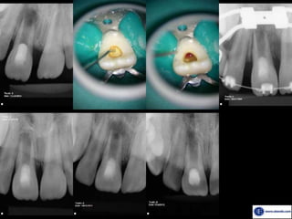 revascularization.pdf