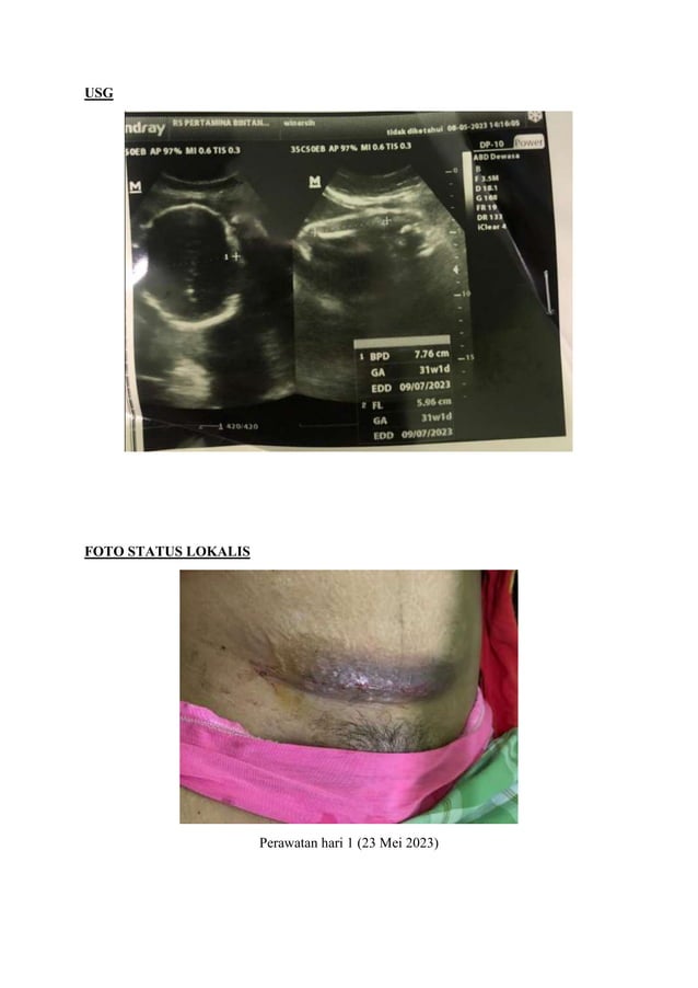 rev case report Obgyn ILO Aulia.docx