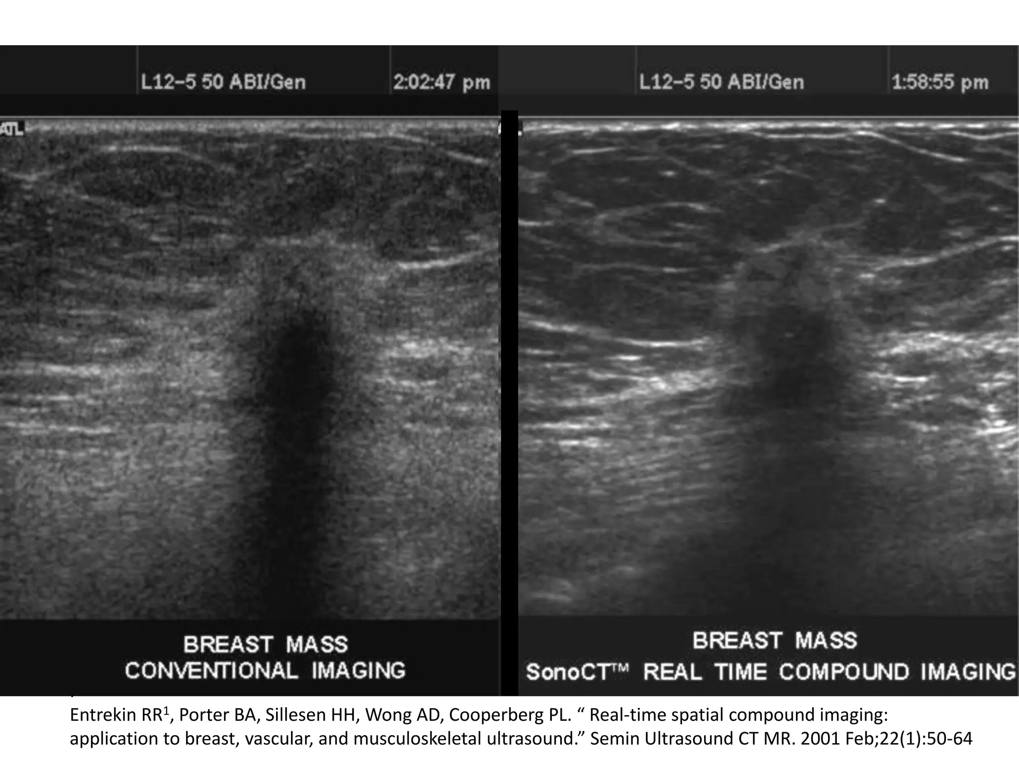 Reverberation Artifacts in ultrasound imaging | PDF