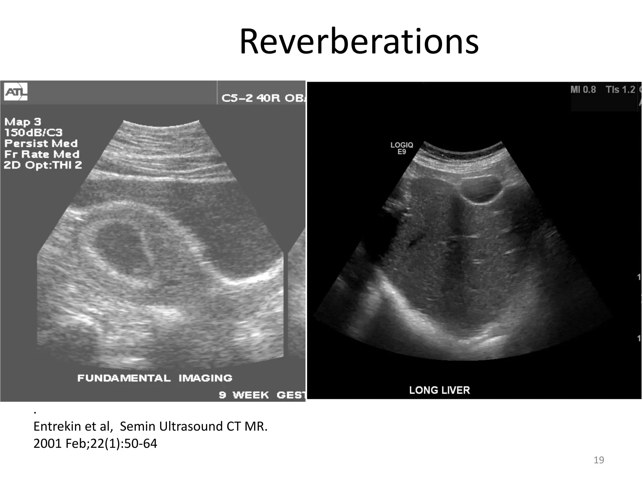 Reverberation Artifacts in ultrasound imaging | PDF
