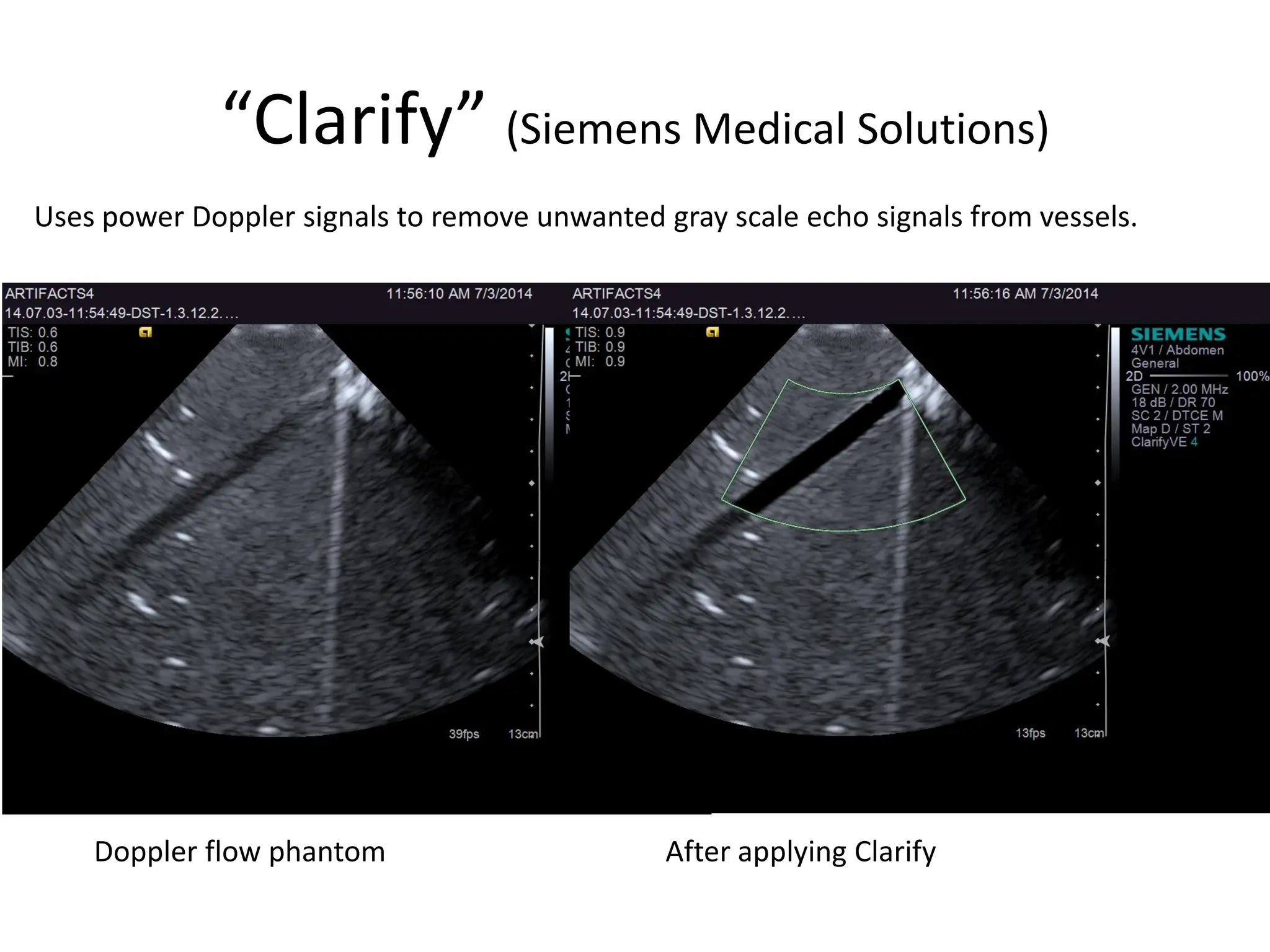 Reverberation Artifacts in ultrasound imaging | PDF