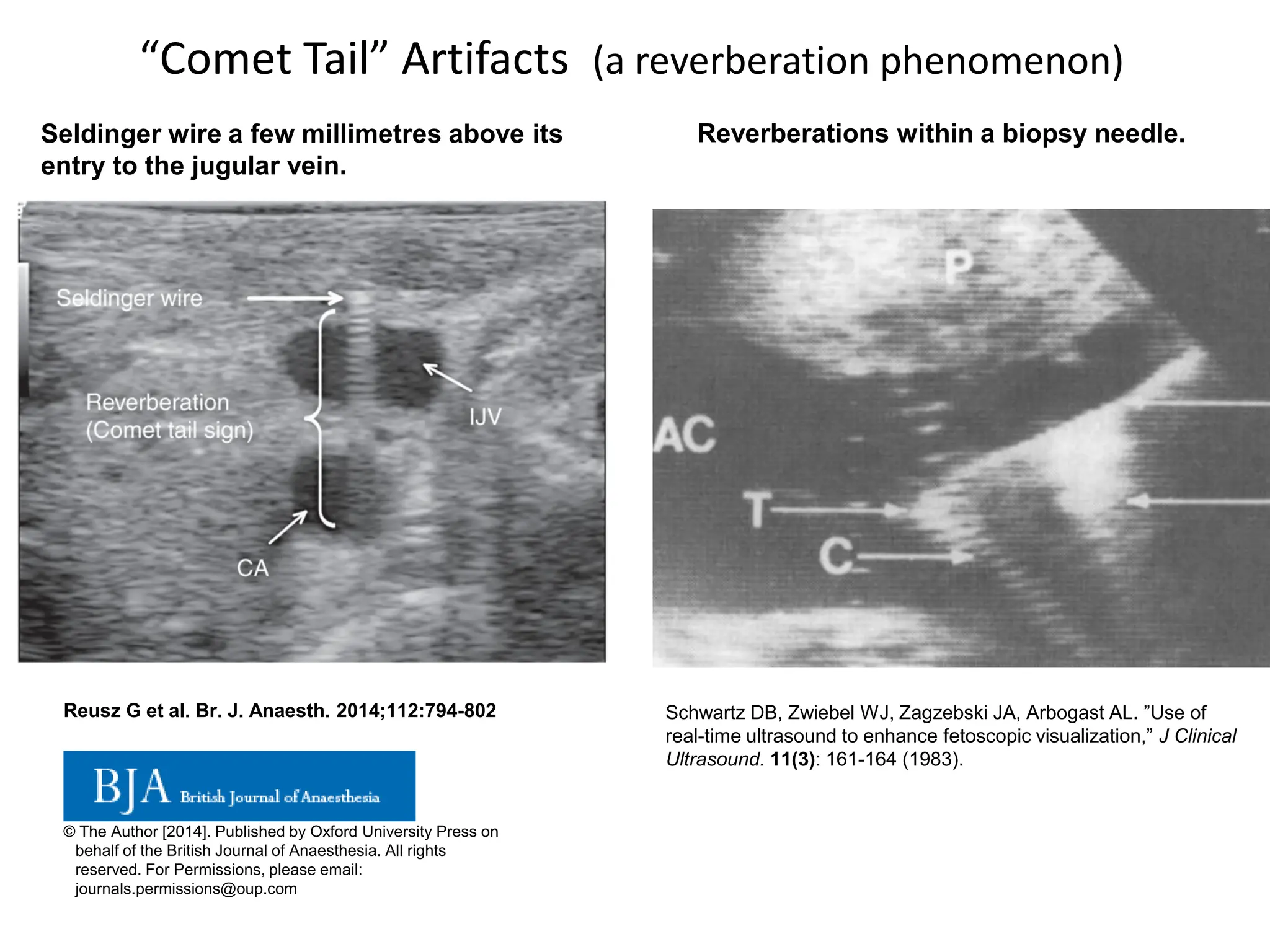 Reverberation Artifacts in ultrasound imaging | PDF