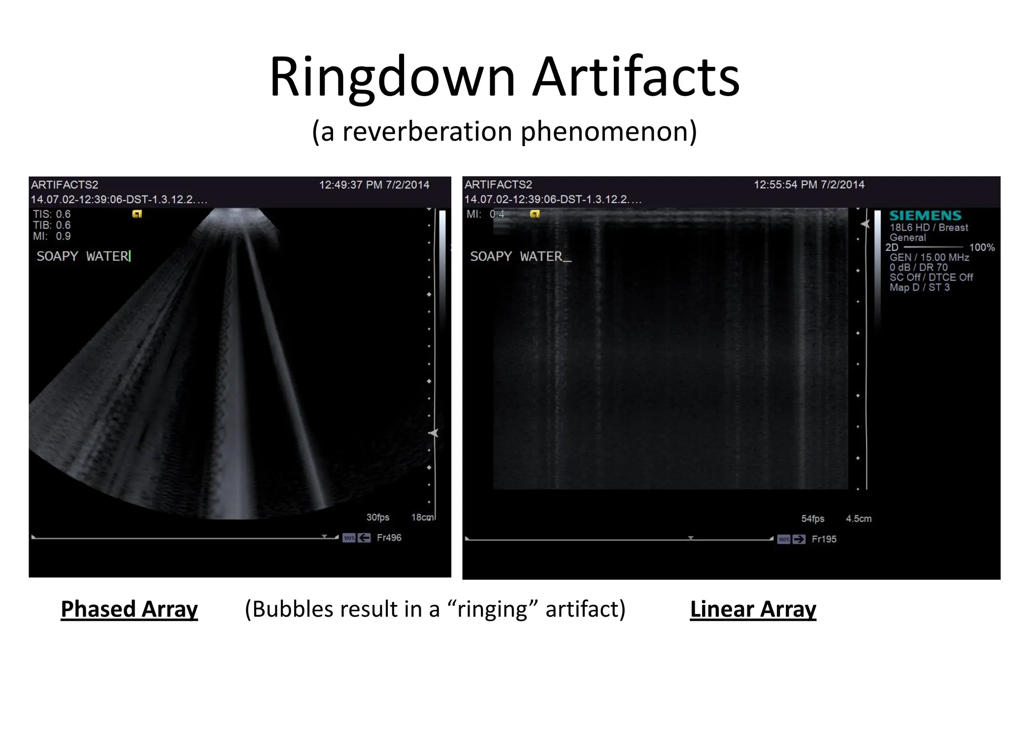Reverberation Artifacts in ultrasound imaging | PDF
