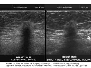 Reverberation Artifacts in ultrasound imaging | PDF
