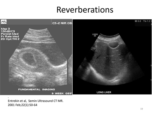 Reverberation Artifacts in ultrasound imaging | PDF