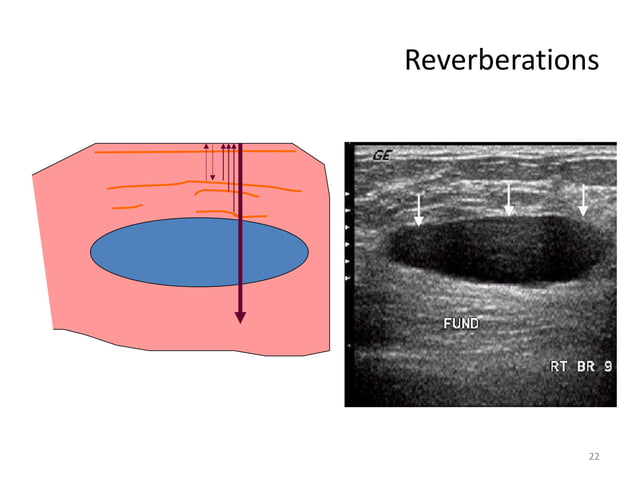 Reverberation Artifacts in ultrasound imaging | PDF