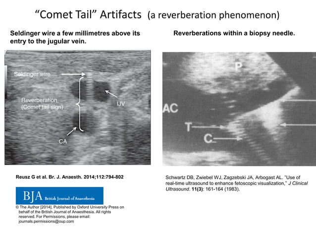 Reverberation Artifacts in ultrasound imaging | PDF