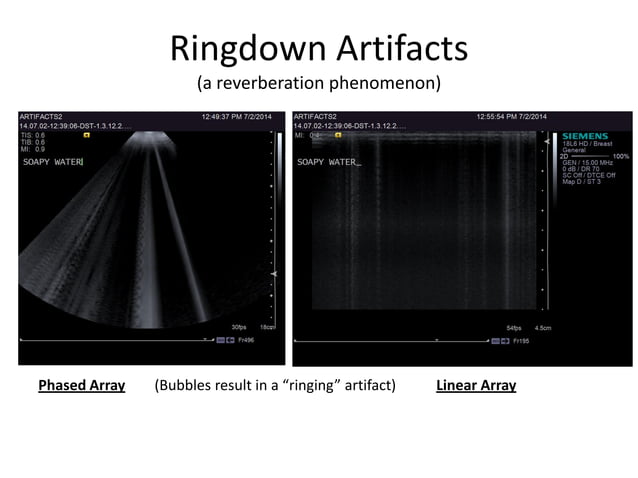 Reverberation Artifacts in ultrasound imaging | PDF