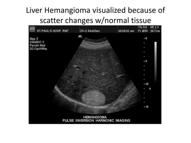 Reverberation Artifacts in ultrasound imaging | PDF