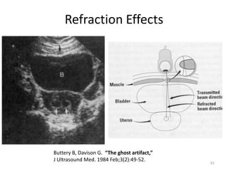 Reverberation Artifacts in ultrasound imaging | PDF