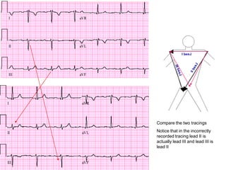Reversal Limb Leads | PPT