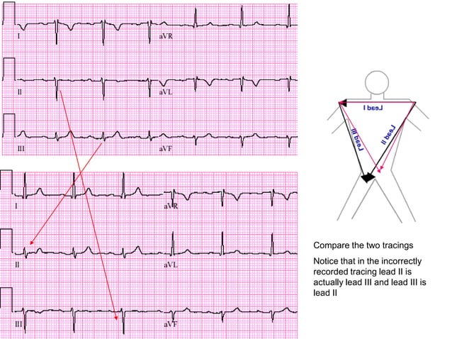 Reversal Limb Leads | PPT