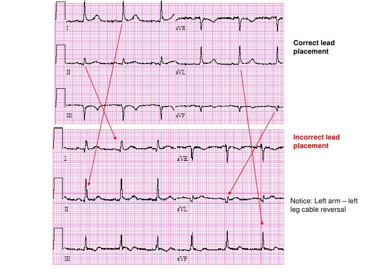 Reversal Limb Leads