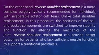 Reverse Shoulder Replacement surgery in Delhi- PPT | PPTX