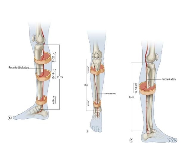 Reverse peroneal artery flap | PPTX