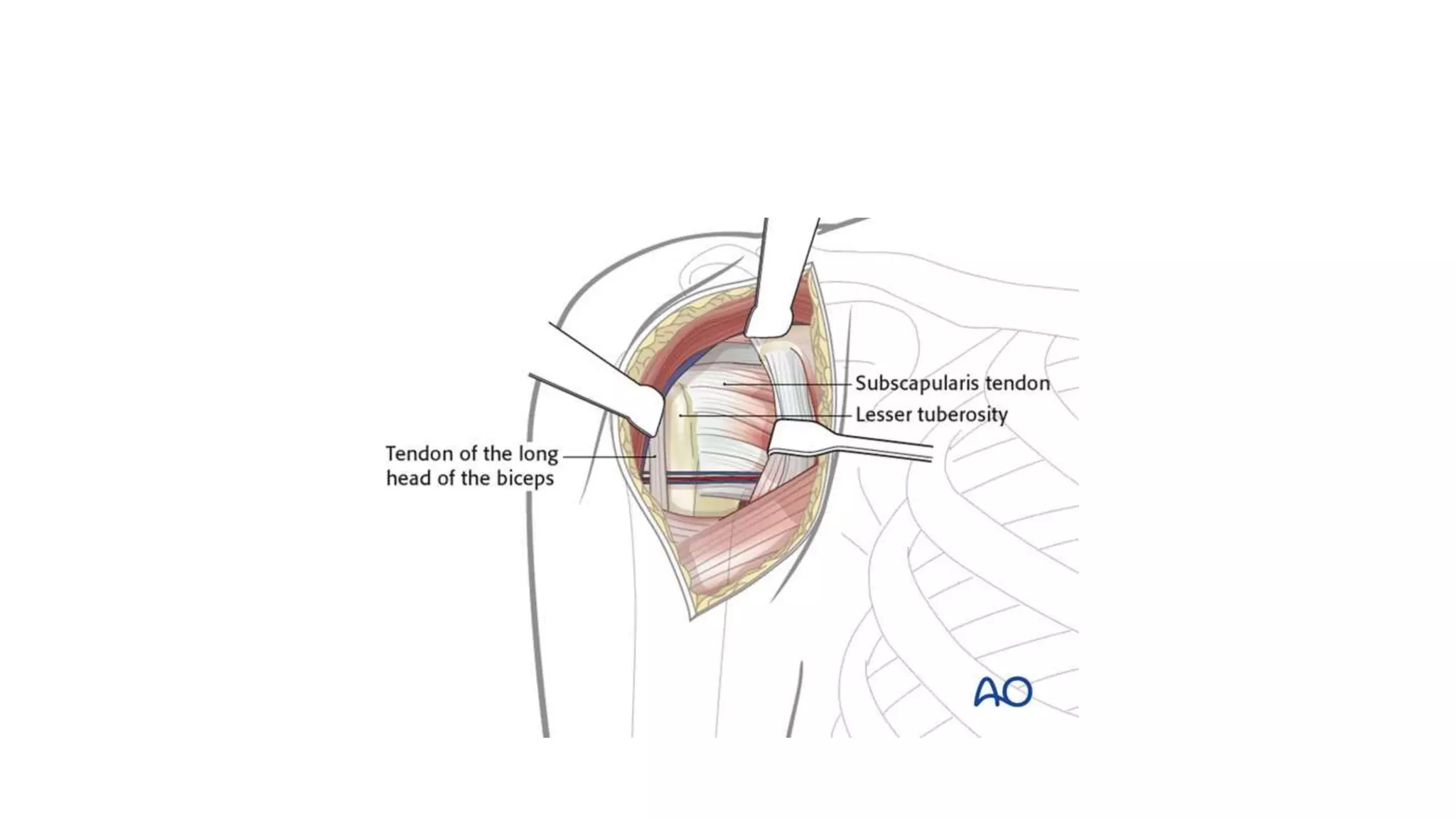 Reverse shoulder arthroplasty | PPTX