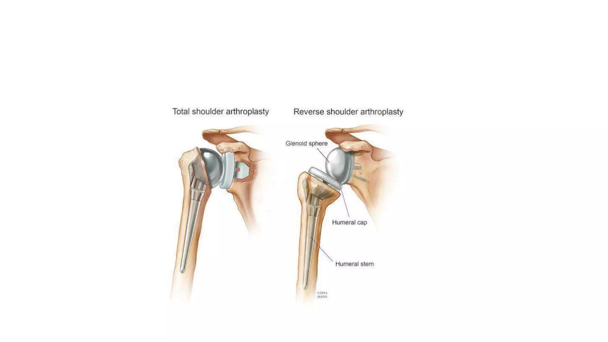 Reverse shoulder arthroplasty | PPTX