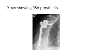 Reverse shoulder arthroplasty | PPTX