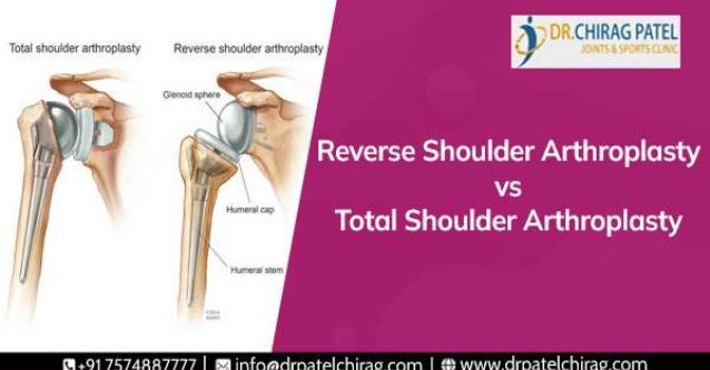 Reverse Shoulder Arthroplasty vs Total Shoulder Arthroplasty | Dr ...