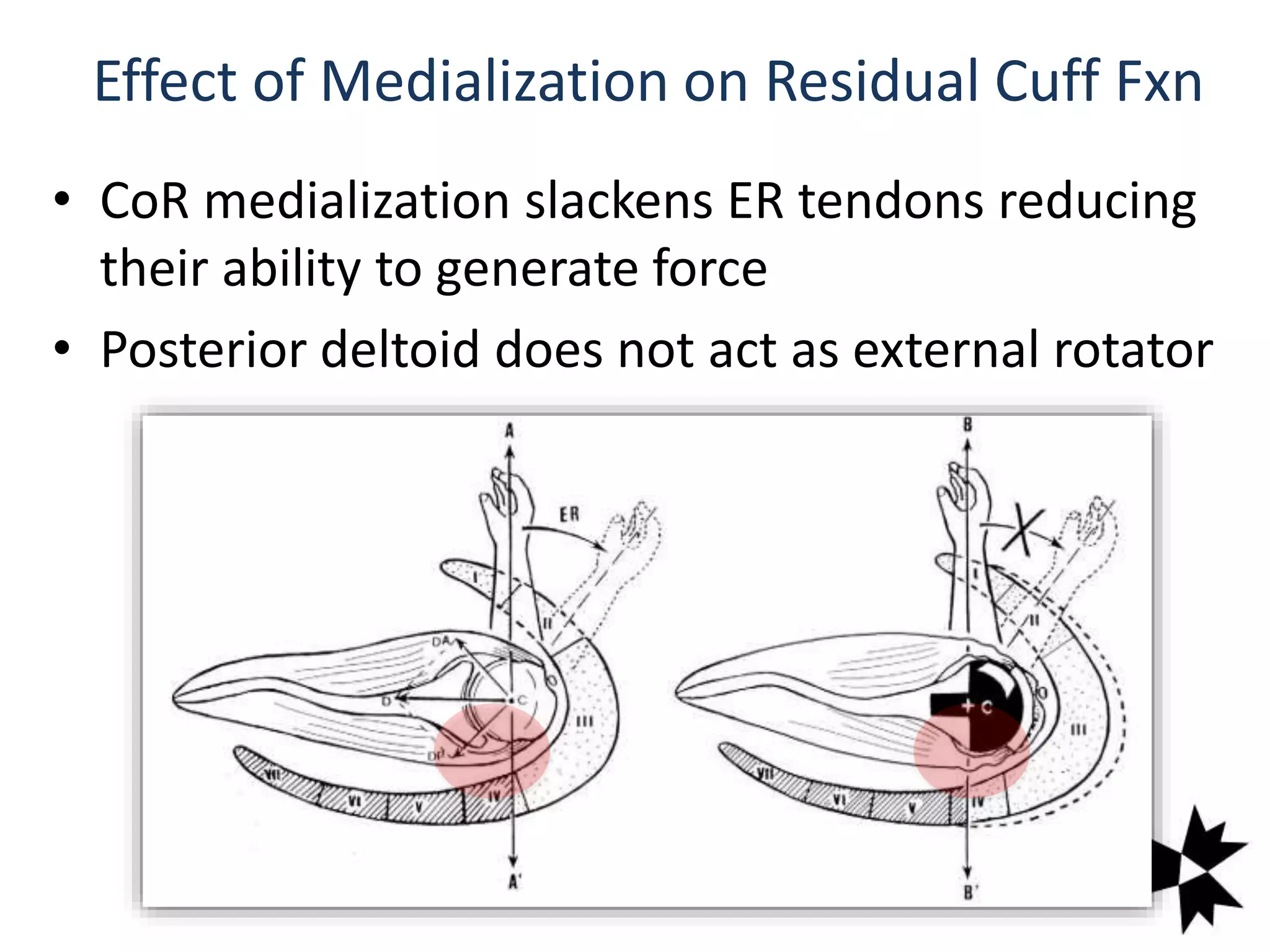 Reverse shoulder biomechanics | PPTX