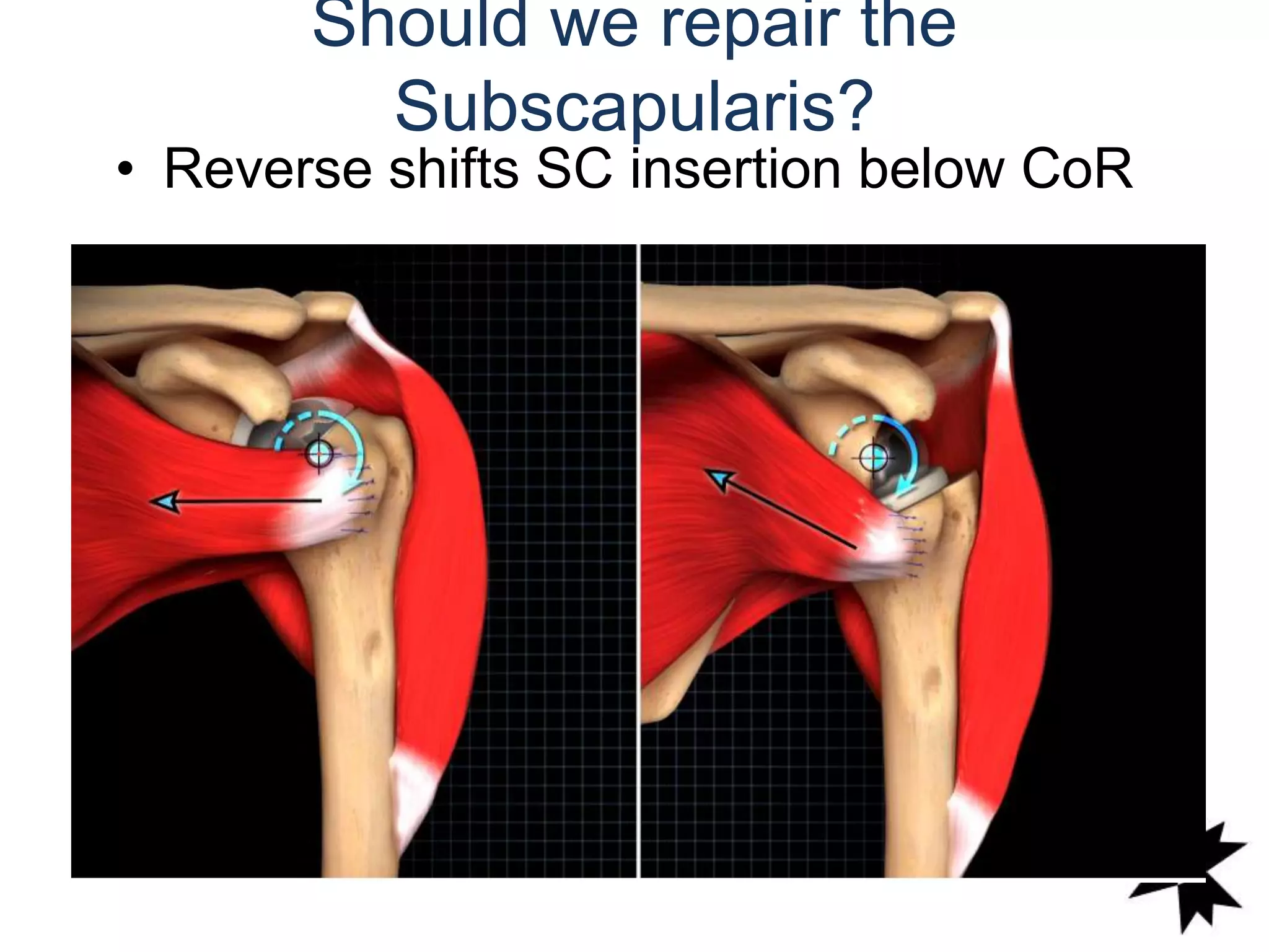 Reverse shoulder biomechanics | PPTX
