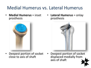 Reverse shoulder biomechanics | PPTX