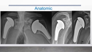 reverse Shoulder presentation.pdf