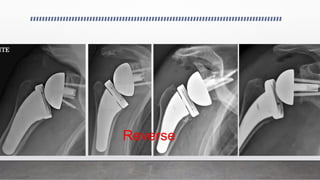 reverse Shoulder presentation.pdf