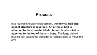 Reverse Shoulder Replacement.pptx